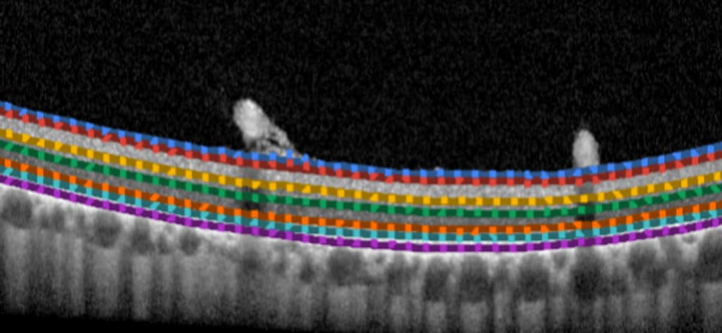Using Machine Learning To Automatically And Accurately Characterize Retinal Images Bioteam